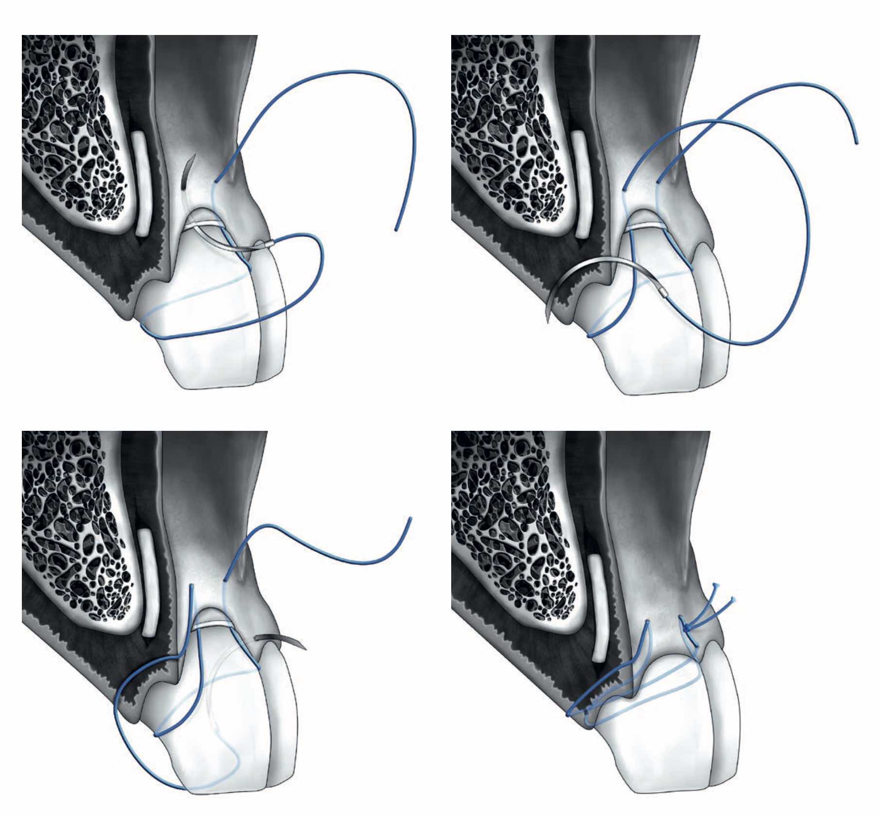 QUINTESSENCE-2024 - The Trapezoidal Sling Suture - Paroplastic